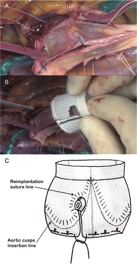 A The Aortic Root Prepared For Valve Sparing Reimplantation The Download Scientific Diagram