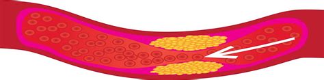 Levels Of Cholesterol Plaque In Vessels Control Disease Heart Vector Control Disease Heart