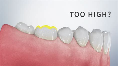 Adjusting A Crown In High Occlusion During Crown Seating Spear Education
