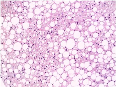 Figure 1 From Prognostic Implication Of Liver Histology In Patients With Nonalcoholic Fatty