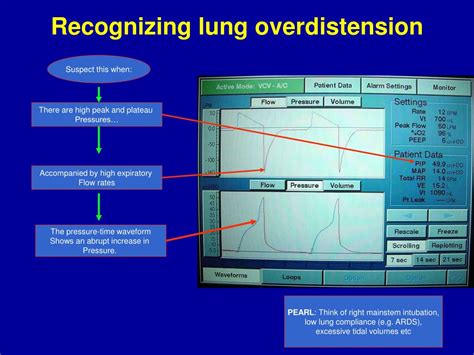 Ppt Ventilator Waveforms Basic Interpretation And Analysis Powerpoint Presentation Id 9090453