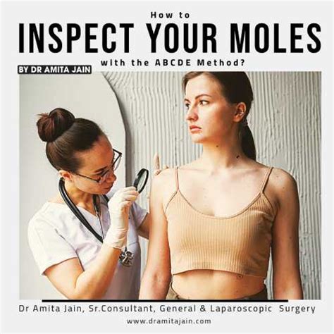 How To Inspect Your Moles With The Abcde Method