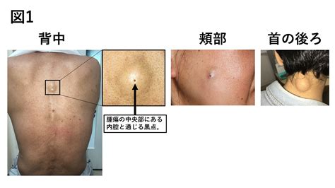 粉瘤（ふんりゅう） みんなの医療ガイド 兵庫医科大学病院