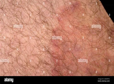 Ringworm Fungal Infection Dark Area At Right On The Skin Of A 69 Year