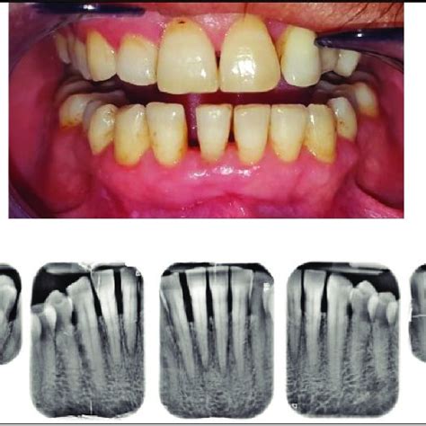 Gingivectomy Gingivoplasty Internal Bevel Incision And Sutures