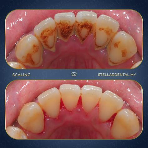 Teeth Scaling Teeth Cleaning Treatment Stellar Dental