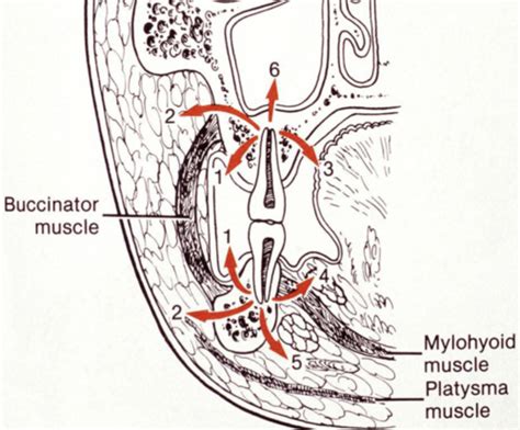6 Complex Odontogenic Infections Flashcards Quizlet
