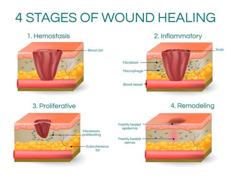 4 Stages Of Wound Healing Wound Healing Heal Wounds Faster Healing
