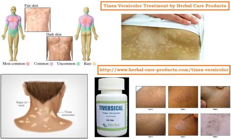 Tiversical Best Herbal Supplement For Tinea Versicolor Natural Health