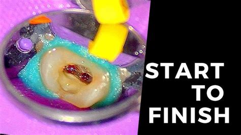 Maxillary Molar Endo Access Ultrasonic Mb2 Troughing 57 Off