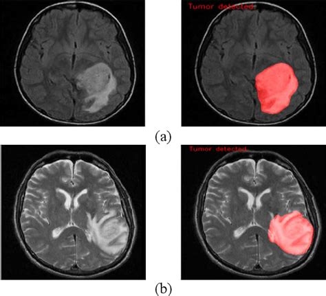 Figure 2 From Brain Tumour Detection And Segmentation Using Cnn