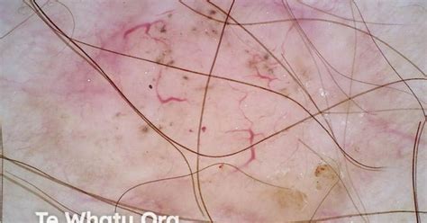 Nodular Basal Cell Carcinoma Nonpolarised Dermoscopy View Image