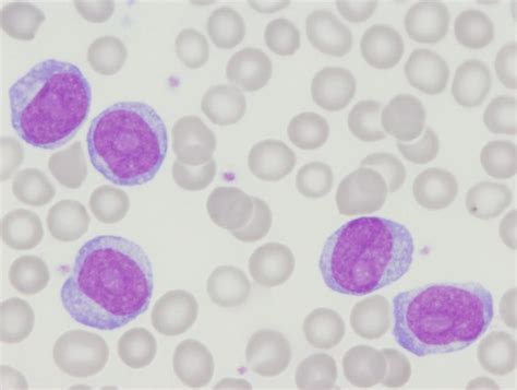 Prolymphocytes