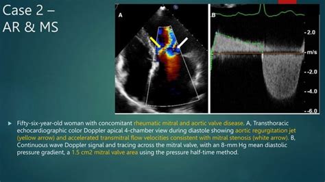 Evaluation Of Mixed Valvular Heart Disease On Echo Pptx Heart And