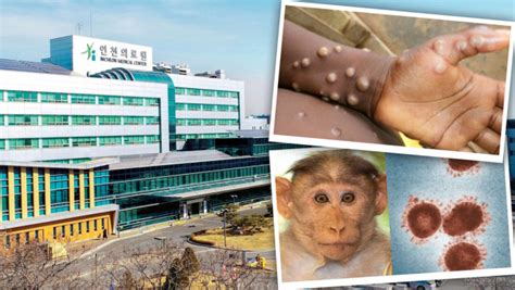 Солонгос улсад сармагчны цэцэг өвчний 2 сэжигтэй тохиолдол бүртгэгджээ