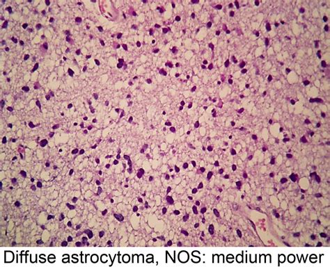 Diffuse Astrocytoma Grade 2 My XXX Hot Girl