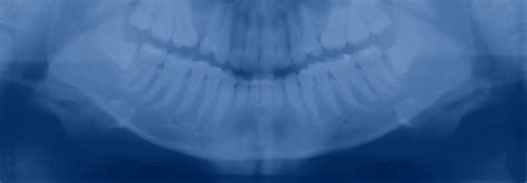 Physio For Jaw Dislocation Pivotal Motion Physiotherapy