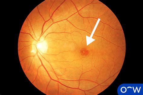 Macular Hole Macular Hole Retinavitreouscentre