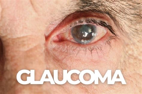The First Sign Of Glaucoma Understanding Its Early Symptoms Flash Uganda Media