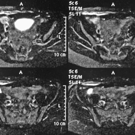 Intussusception Sonographically Guided Hydrostatic Reduction By Download Scientific Diagram