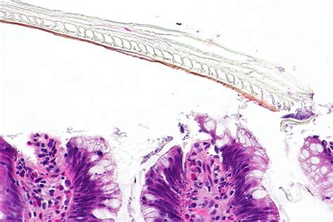 Fecal Material Libre Pathology