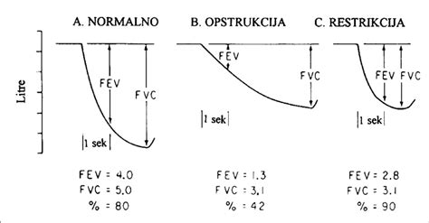 Normal Obstructive And Restrictive Patterns Of A Forced Expiration
