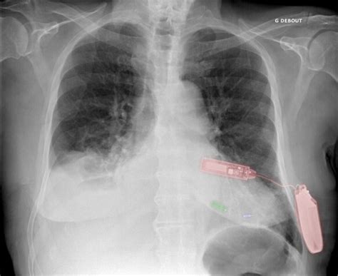 What Is New In Heart Failure Management Ultrasonic Cardiac Re