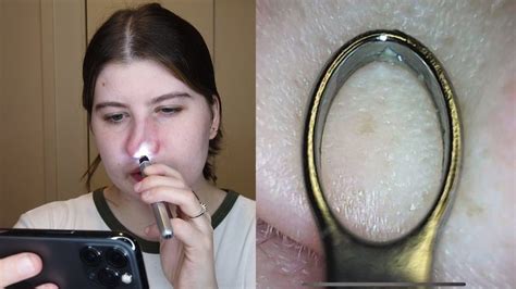 Blackhead Removing Loop Tool Has Built In Microscope Business Insider