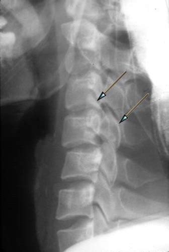Cervical Spine Tech MT Flashcards Quizlet