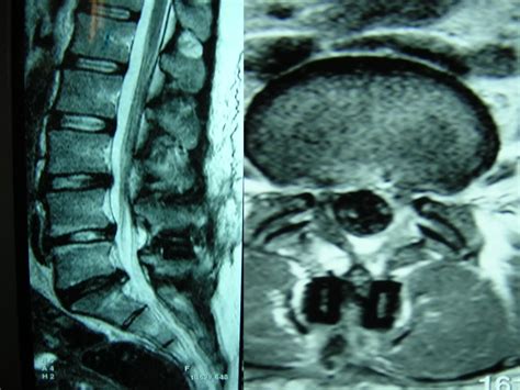 Dynamic Stabilization Ppt