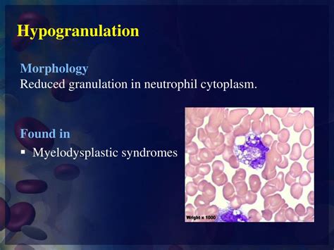Ppt Wbcs And Plt Abnormal Morphology Powerpoint Presentation Free Download Id6378150
