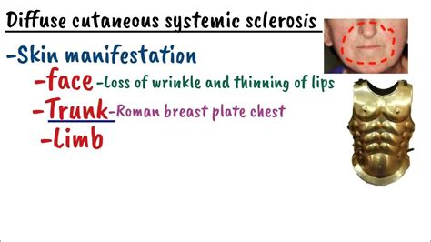 Scleroderma L Systemic Sclerosis Crest Syndrome Rheumatology Medicine Youtube