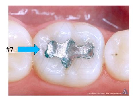 Restorations Flashcards Quizlet