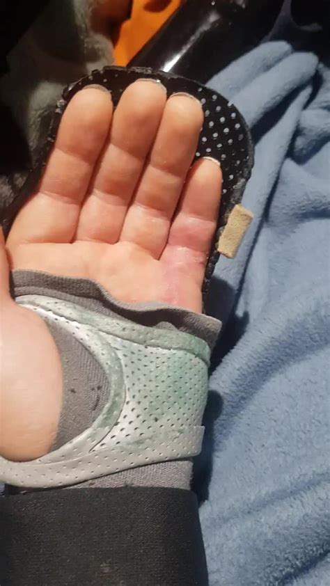 Fdp Tendon 5 Weeks Post Operation Album On Imgur