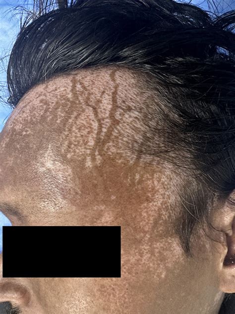 Indian Journal Of Postgraduate Dermatology Current Issue