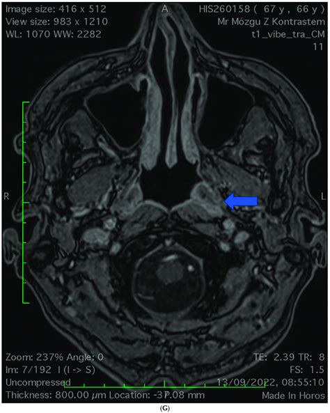 A Patient 1 The Initial Stage Of The Disease Ct Scan Download Scientific Diagram