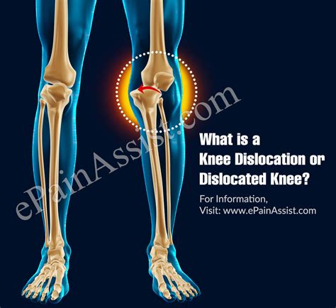 Knee Dislocation Or Dislocated Knee Causes Classification Symptoms