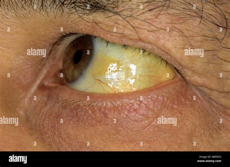 Jaundice Eye Sclera At Sarah Fox Blog