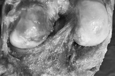 Insertion Of The Posterior Cruciate Ligament From The Posterior Tibial Download Scientific