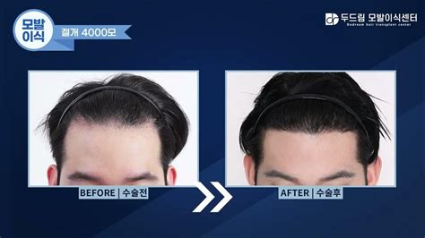 모발이식 남성 모발이식 전후 영상 절개 4000모 Youtube