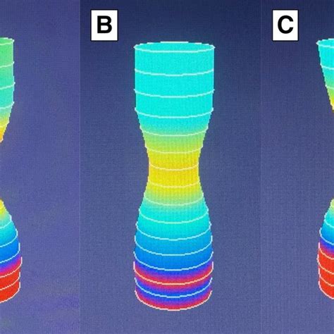 Comparison Of Distensibility Index Di Prior To Surgery After Myotomy