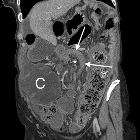 Contrast Enhanced Ct Image Axial Projection On Day 3 Displaying The Download Scientific