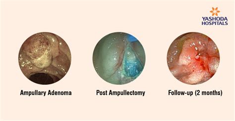 Endoscopic Ampullectomy With Ercp For Ampullary Adenomas Yashoda