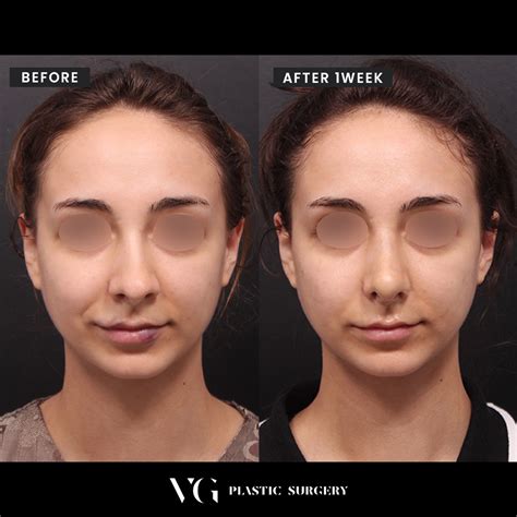 Vg Plastic Surgery Korea Verygood Plasticsurgery • Instagram Photos And Videos