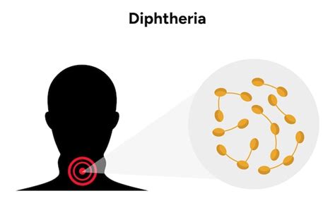 Diphtheria Toxin Vectors And Illustrations For Free Download