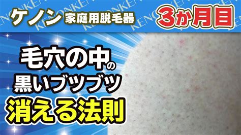 【ケノン脱毛】3カ月目の脱毛効果と新たにわかった実験結果を発表 Youtube