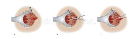Sphincterotomy Procedure For Anal Fissure Stock Illustration