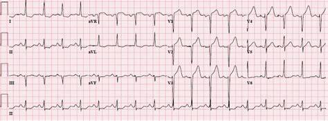 Lvh With Anterior St Elevation When Is It Anterior Stemi Dr Smiths Ecg Blog