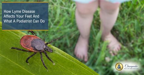 How Lyme Disease Affects Your Feet And What A Podiatrist Can Do