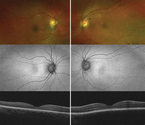 A Case Series Of Occult Macular Dystrophy Ocl